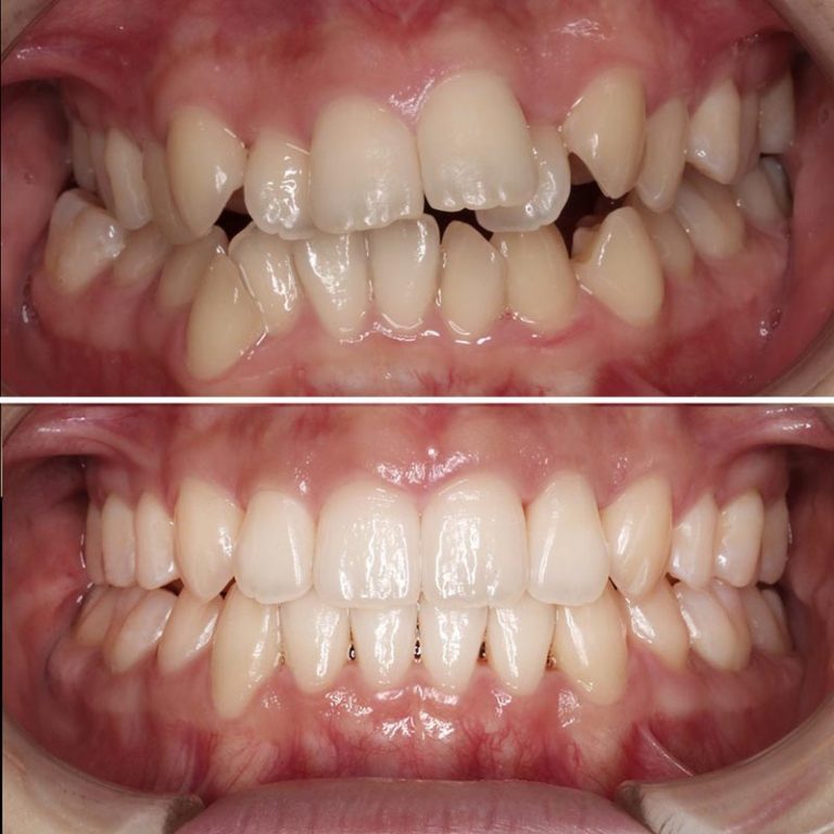 Professional Invisalign on Harley Street | Pro Dental Clinic