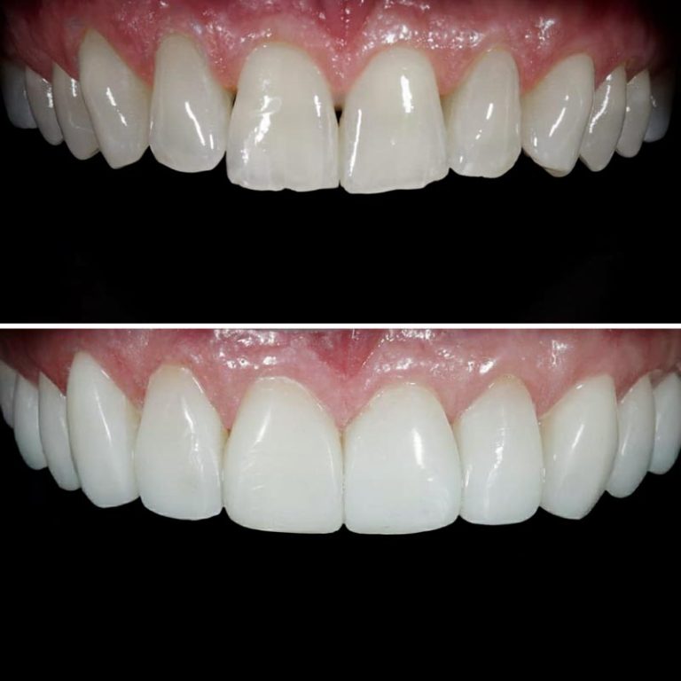 Composite Veneers on Harley Street | Pro Dental Clinic