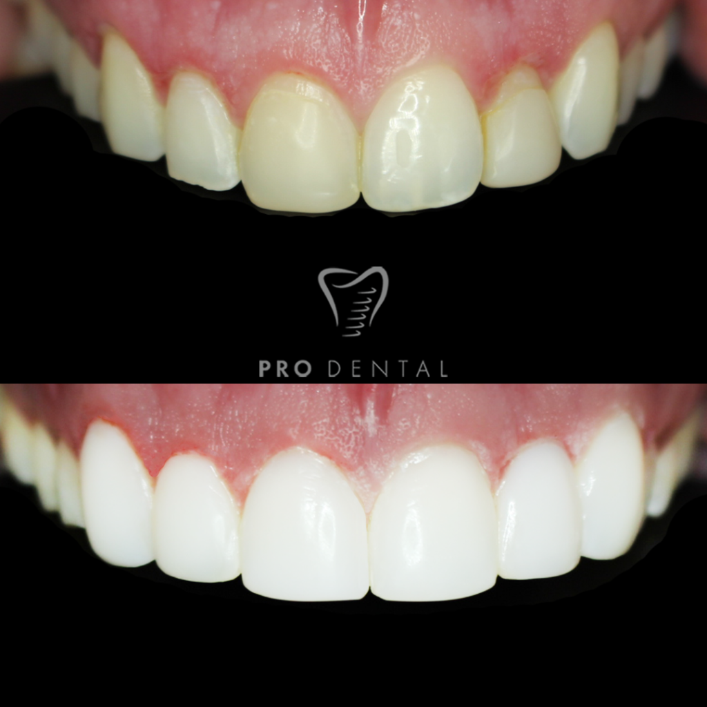 Composite Veneers - Pro Dental - Harley Street Composite Treatment