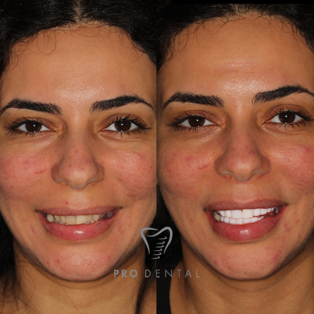 Composite Bonding on Harley Street | Pro Dental Clinic