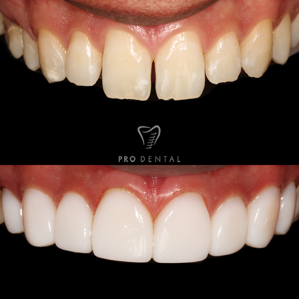 Composite Bonding Smile Makeover Results