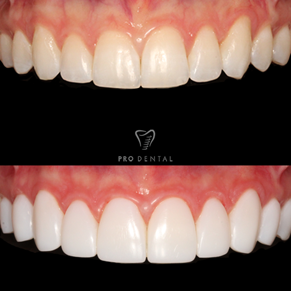 Composite Veneers on Harley Street | Pro Dental Clinic