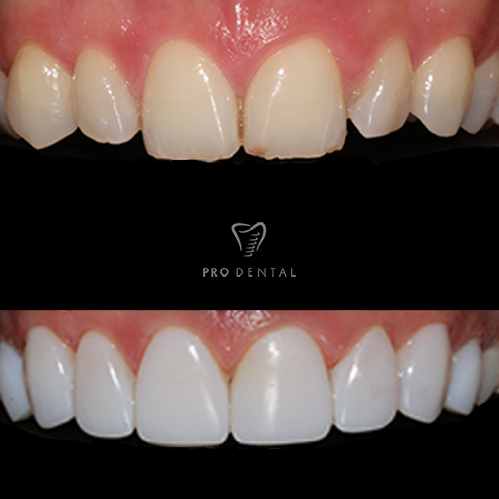 Composite Veneers on Harley Street | Pro Dental Clinic