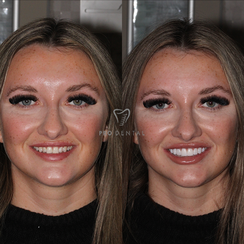 Composite Bonding on Harley Street | Pro Dental Clinic