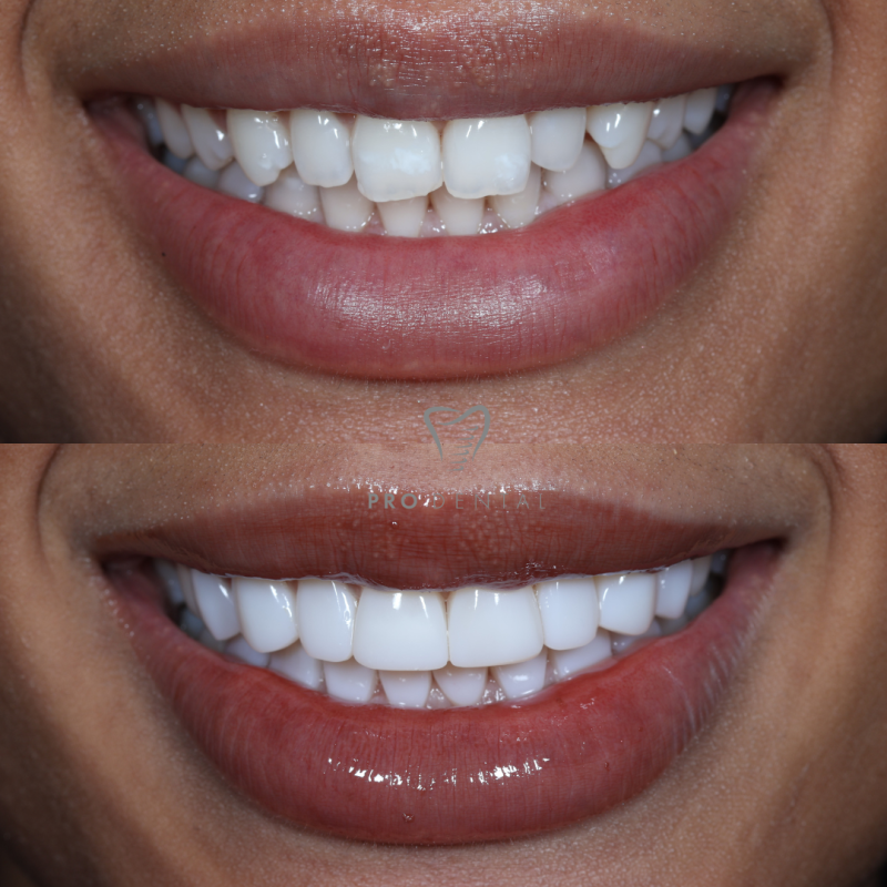 Composite Veneers on Harley Street | Pro Dental Clinic